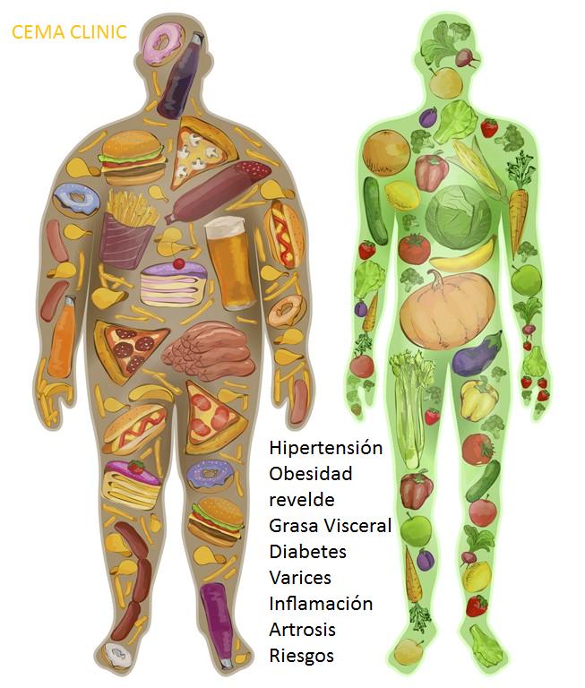 Tipos de Obesidad | Las causas y tratamiento| CEMA CLINIC